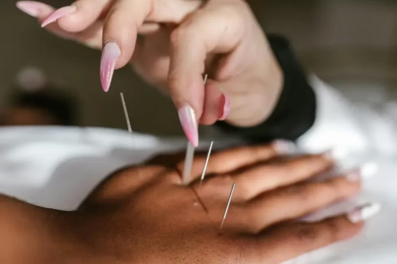 Acupuncture Therapy – traveling reflief Rev